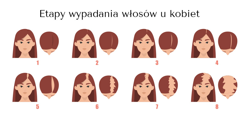 ysienie Androgenowe Przyczyny Objawy Skuteczna Dieta ysienie Androgenowe Przyczyny Objawy Skuteczna Dieta