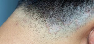 Pimples and scabs on the head. Causes, prevention