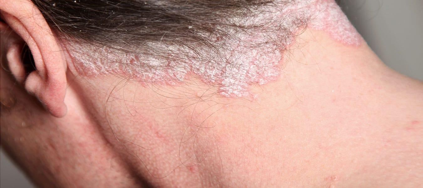 Scalp psoriasis - symptoms and treatment • Dr Piotr Turkowski