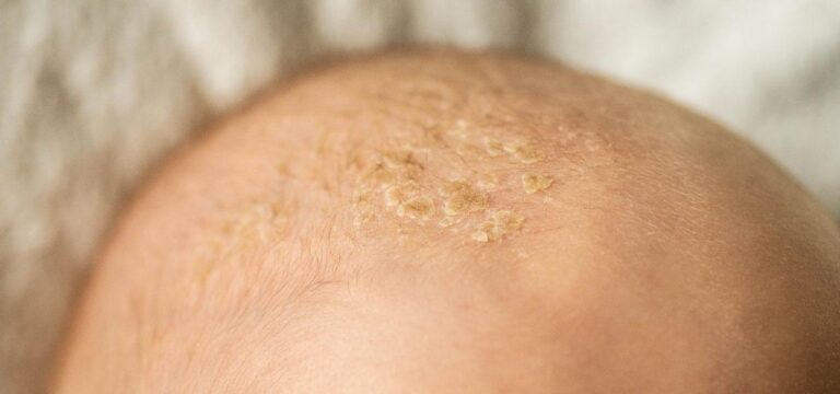 Cradle Cap – Symptoms And Treatment