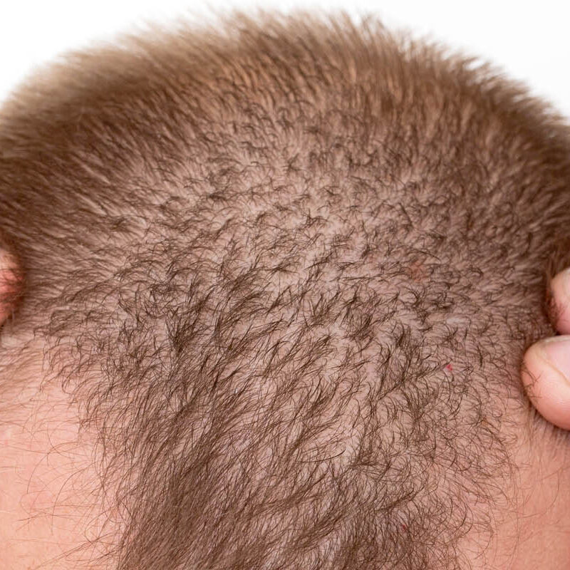 Finasteryd na łysienie - opinie, efekty i skutki uboczne